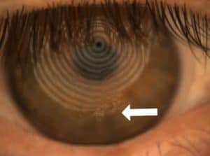 What Happens When You Wear Contacts Too Long?