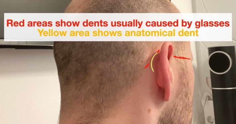 Do Glasses Dent Your Skull?