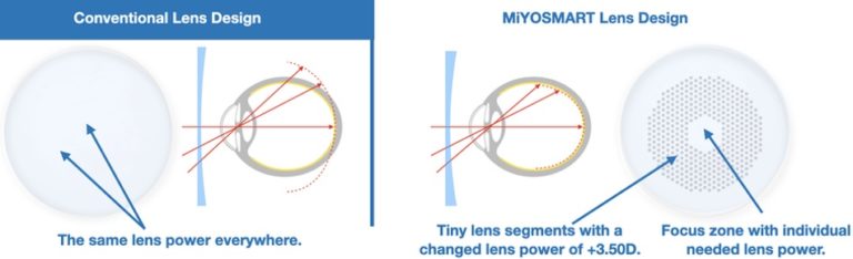 Experience With the MiYOSMART Lenses From Hoya