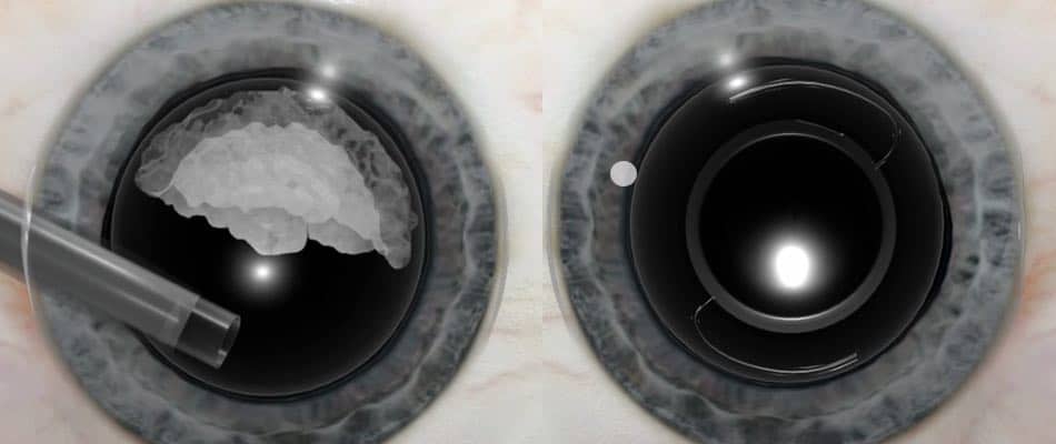 How Is Cataract Surgery Done? – 6 Steps Explained